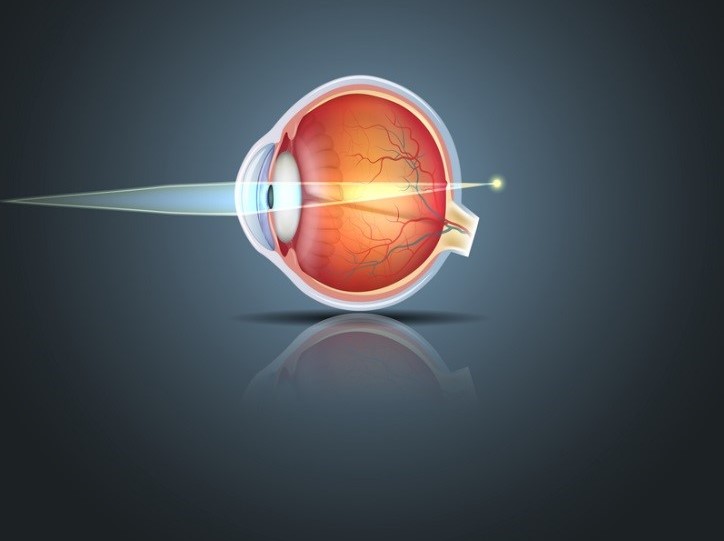 Verziendheid, of hypermetropie is een veelvoorkomende oogafwijking.